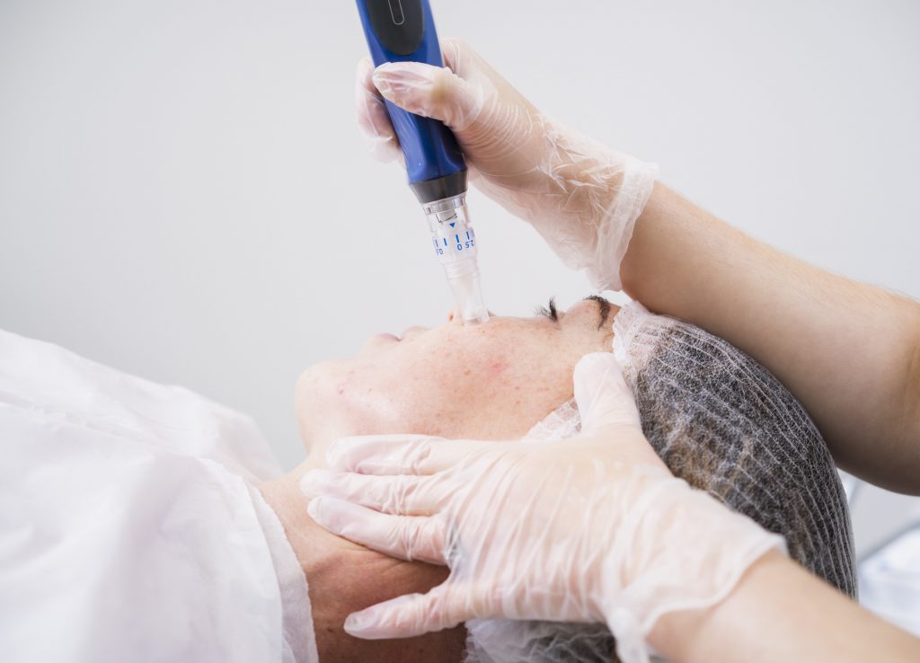 What You Can Expect from Micro-needling Skin Treatment - Cosmetik Clinic